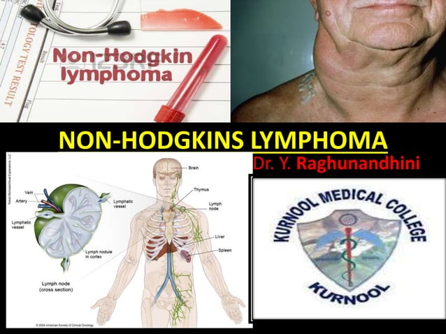 Non hodgkins lymphoma nandhu | PPTX | Blood Disorders | Diseases and Conditions