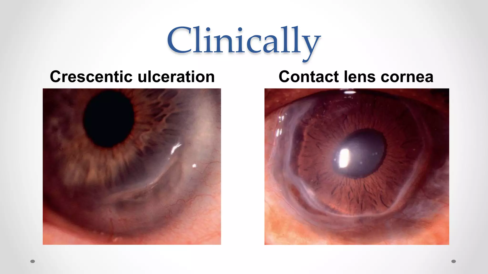 Non infectious corneal ulcers | PPTX