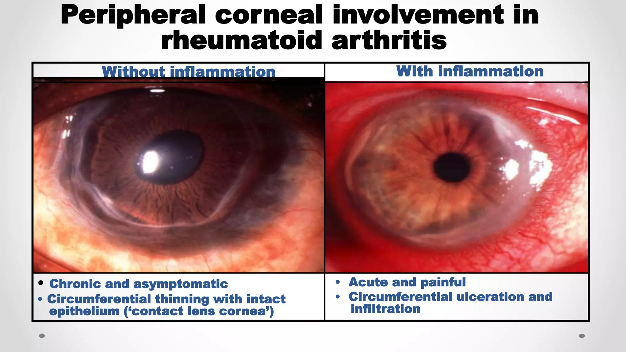 Non infectious corneal ulcers | PPTX