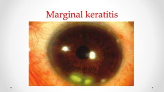 Non infectious corneal ulcers | PPTX