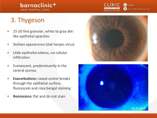 Noninfectious keratitis barnaclinic