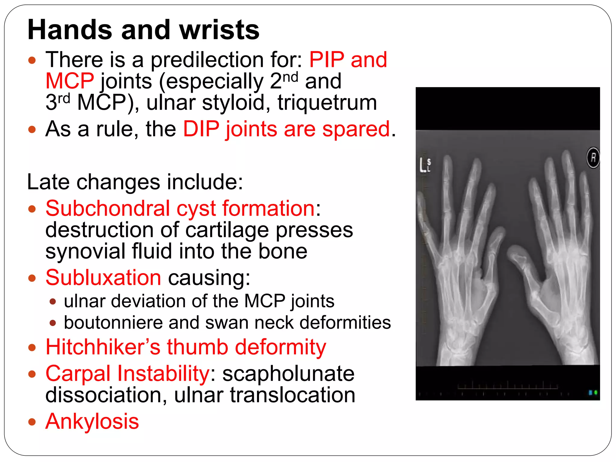 Noninfective inflammatory arthropathy- RHEUMATOID ARTHRITIS | PPT