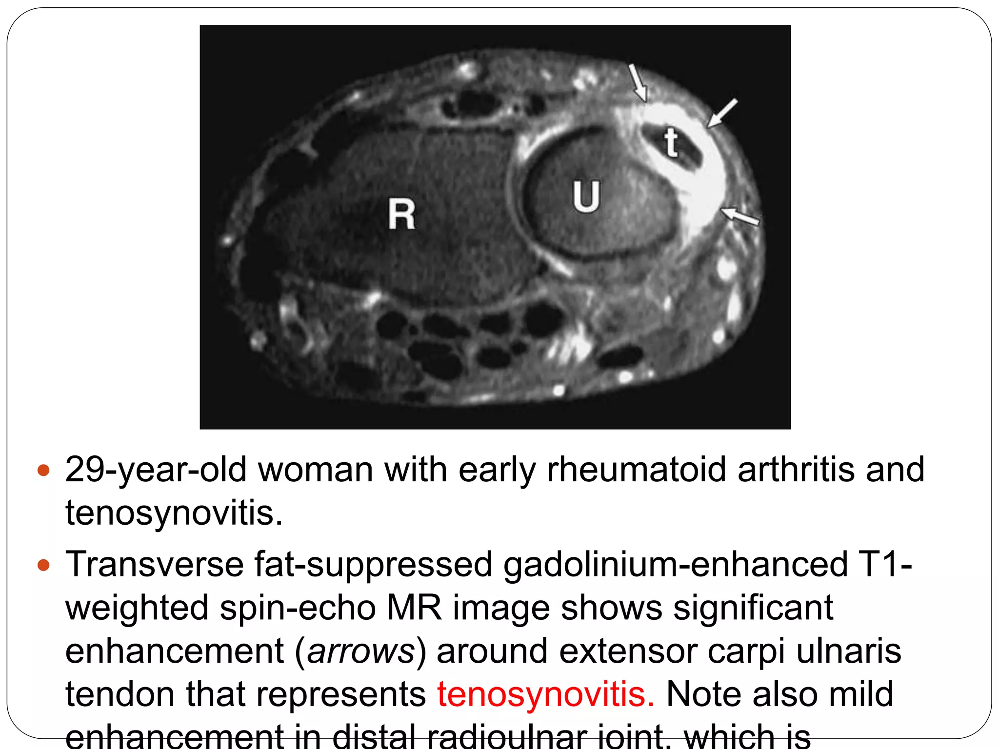 Noninfective inflammatory arthropathy- RHEUMATOID ARTHRITIS | PPTX