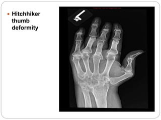 Noninfective Inflammatory Arthropathy Rheumatoid Arthritis Pptx
