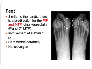 Noninfective inflammatory arthropathy- RHEUMATOID ARTHRITIS | PPTX