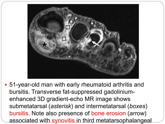 Noninfective inflammatory arthropathy- RHEUMATOID ARTHRITIS | PPT