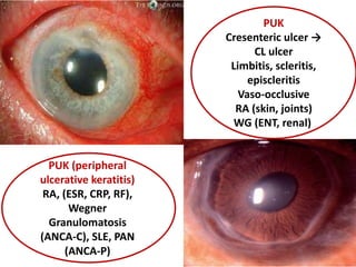 Non infective keratitis ZOH 2021 | PPT