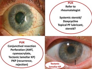 Non infective keratitis ZOH 2021 | PPT