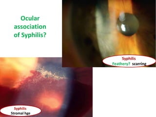 Non infective keratitis ZOH 2021 | PPT