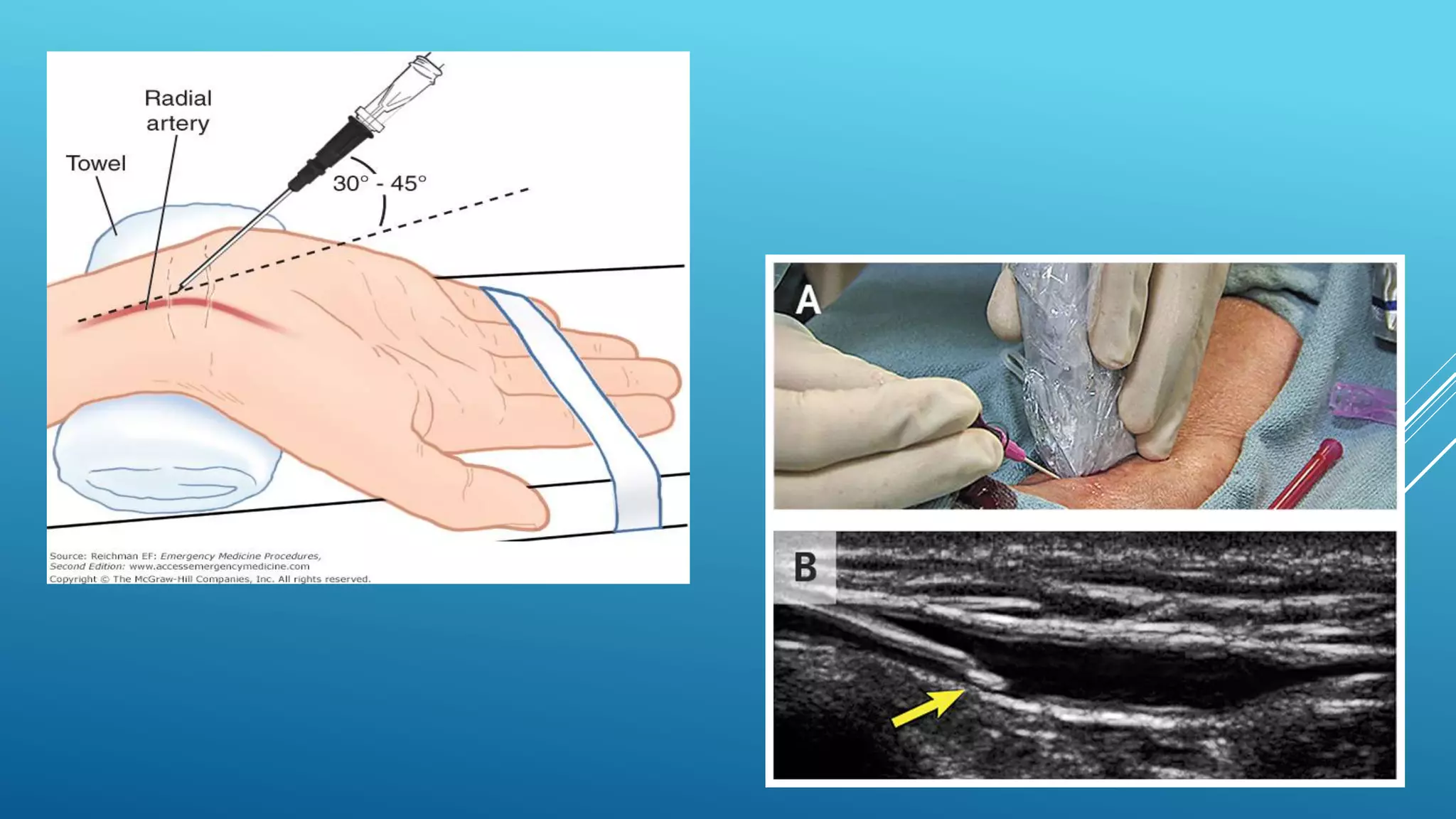Non invasive and_invasive_bp_monitoring__copy | PPTX