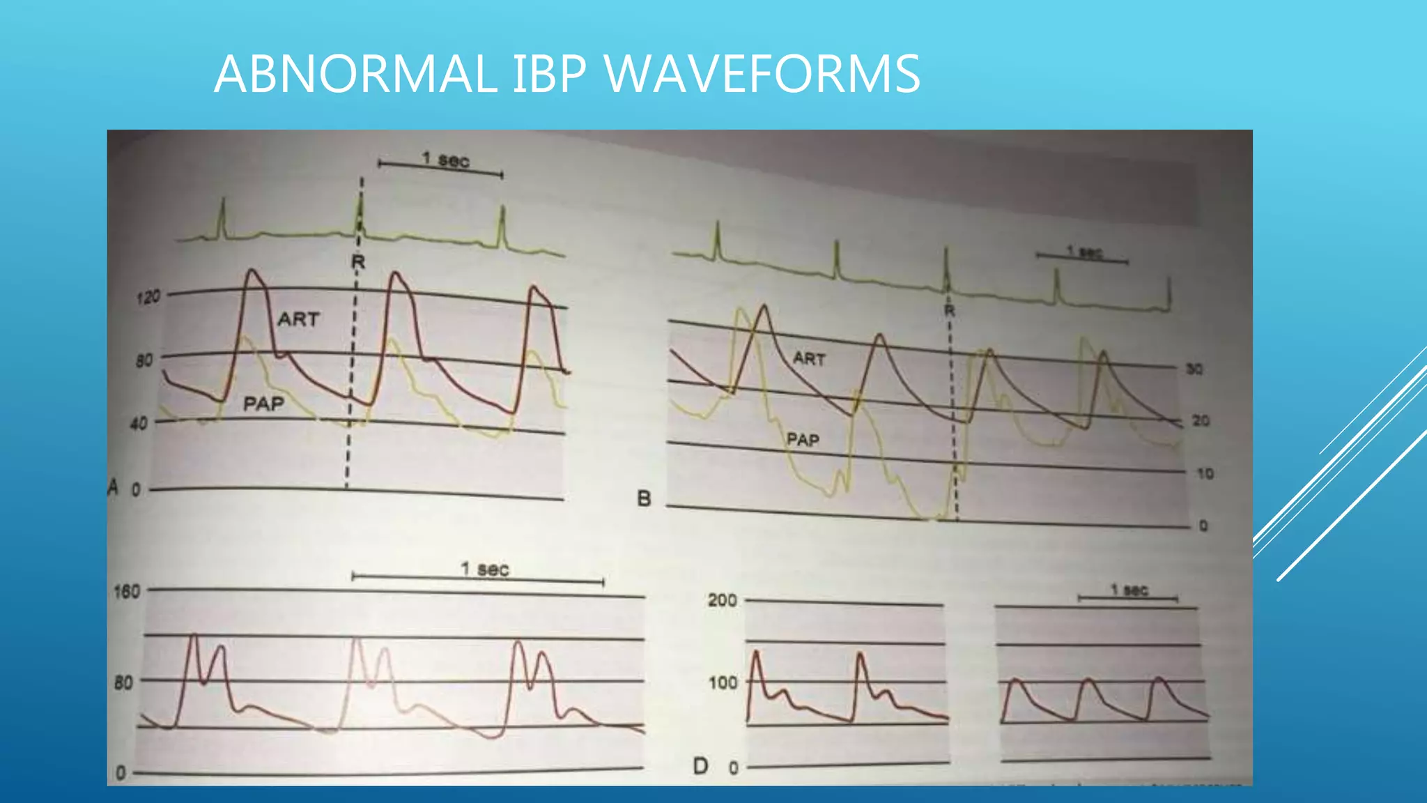 Non invasive and_invasive_bp_monitoring__copy | PPTX