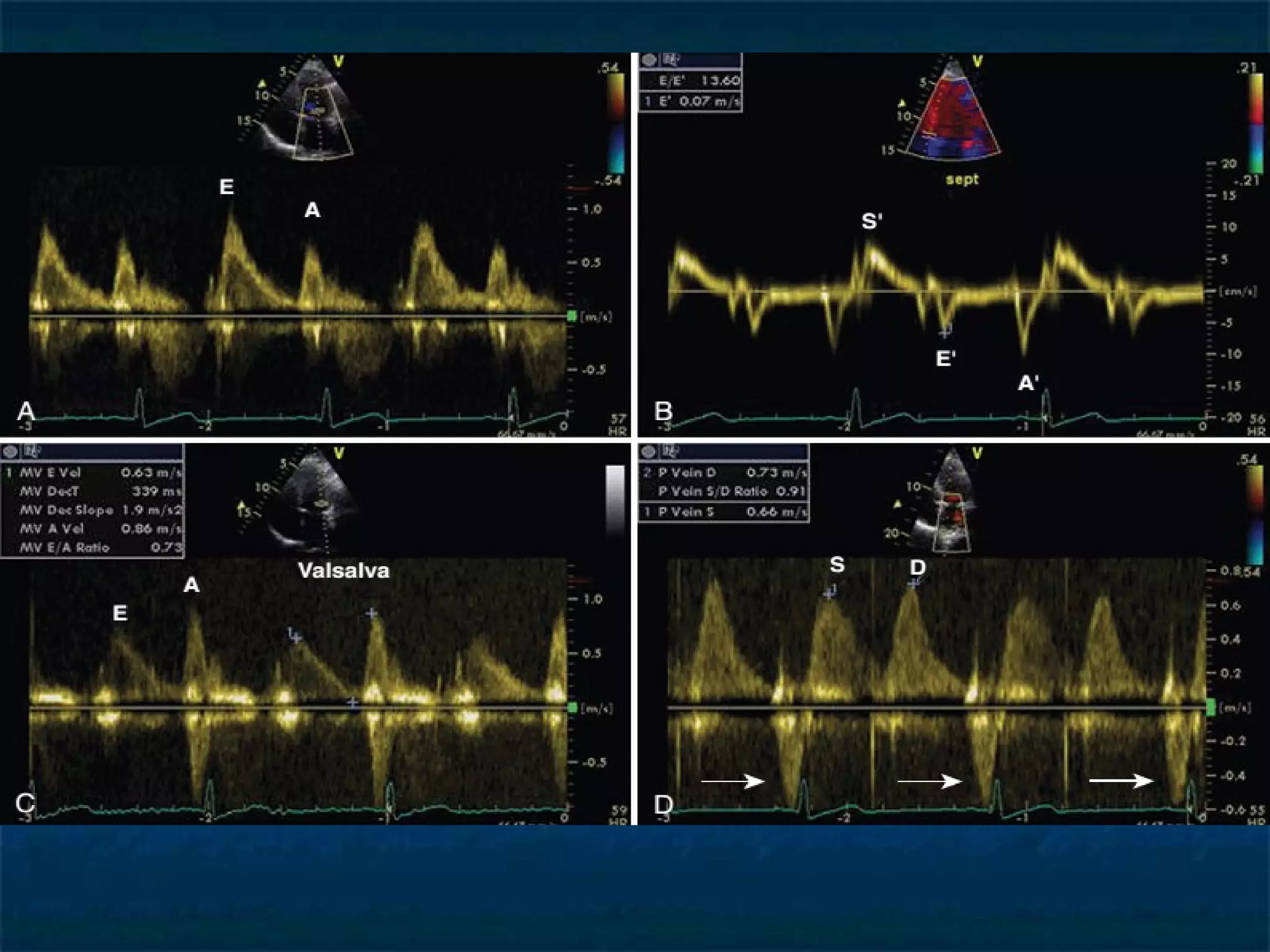 Non invasive diagnosis of hf | PPT