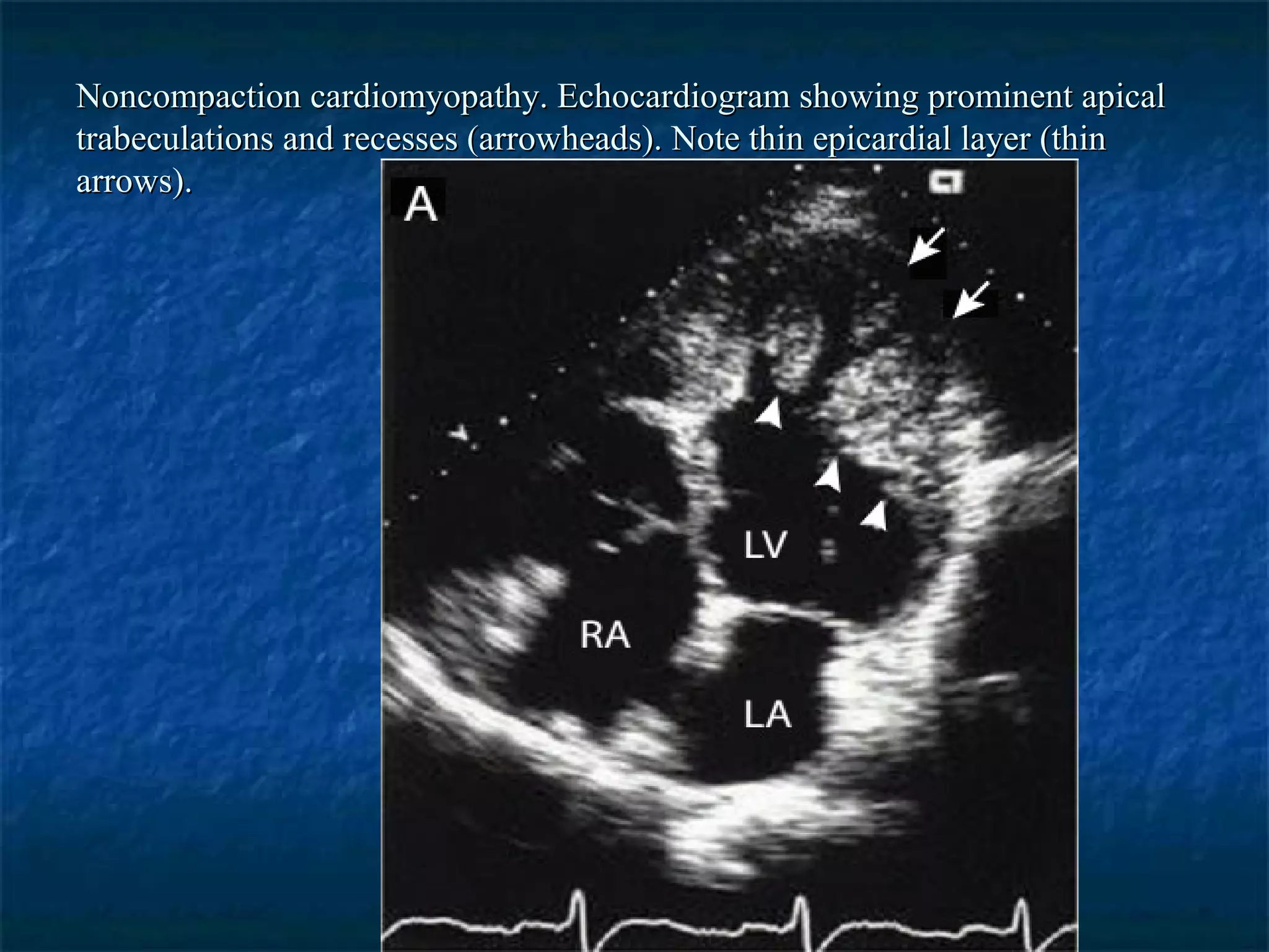 Non invasive diagnosis of hf | PPT