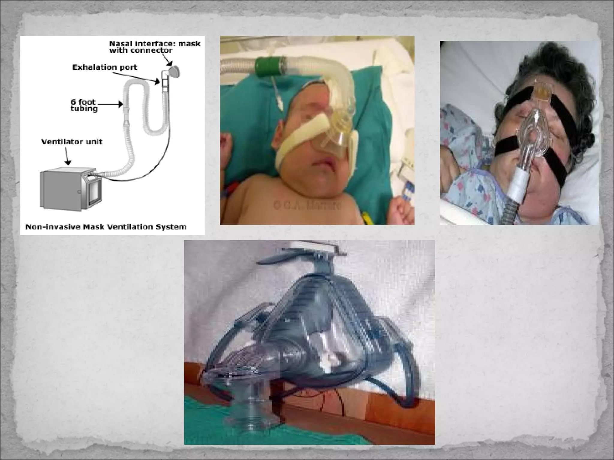 Non invasive ventilation | PPT