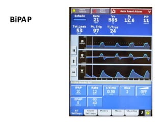 Non invasive ventilations | PPT