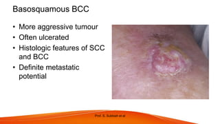 NON MELANOMA SKIN CANCERS IN HEAD AND NECK.pptx