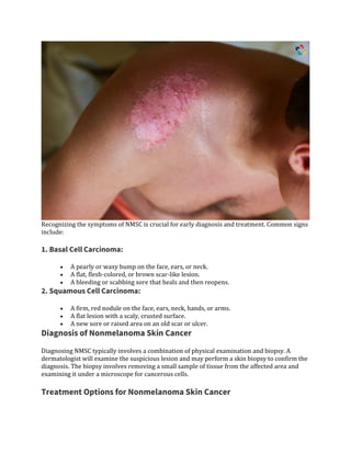 Nonmelanoma Skin Cancer: Types, Causes, Symptoms and Treatment | The ...