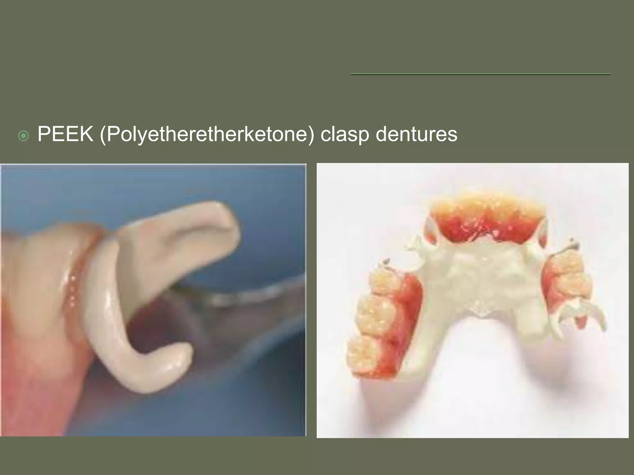 Non-metal clasp removable partial dentures using CAD CAM | PPTX ...