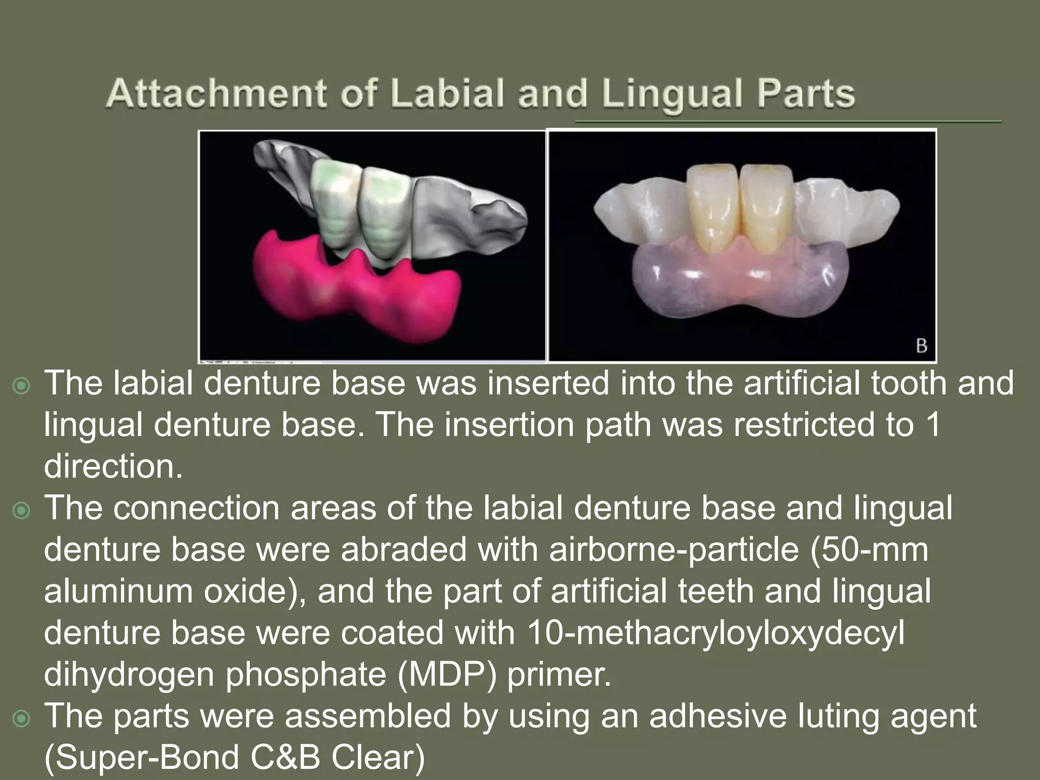 Non-metal clasp removable partial dentures using CAD CAM | PPTX