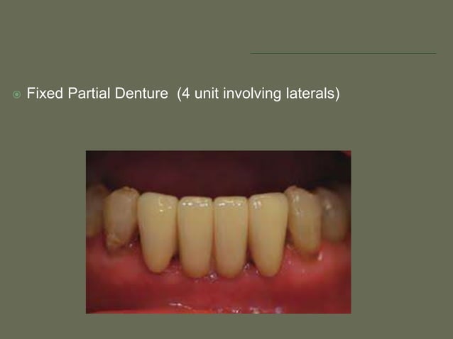 Non-metal clasp removable partial dentures using CAD CAM | PPTX ...