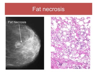 Non neoplastic breast lesions | PPTX