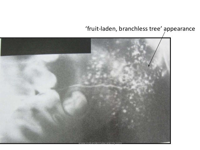 Non neoplastic lesions of the salivary gland / oral surgery courses