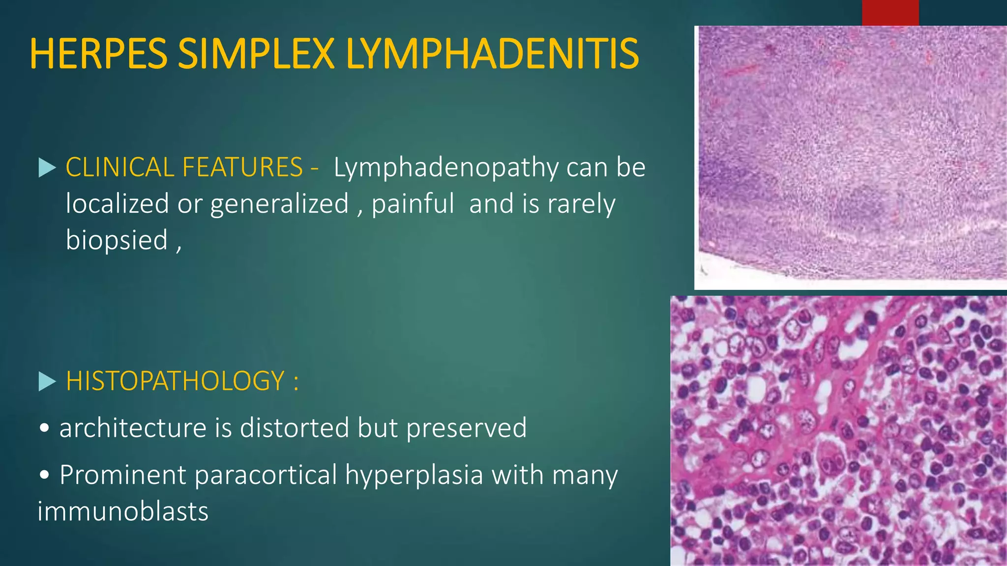 Non neoplastic lymphadenopathy | PPTX