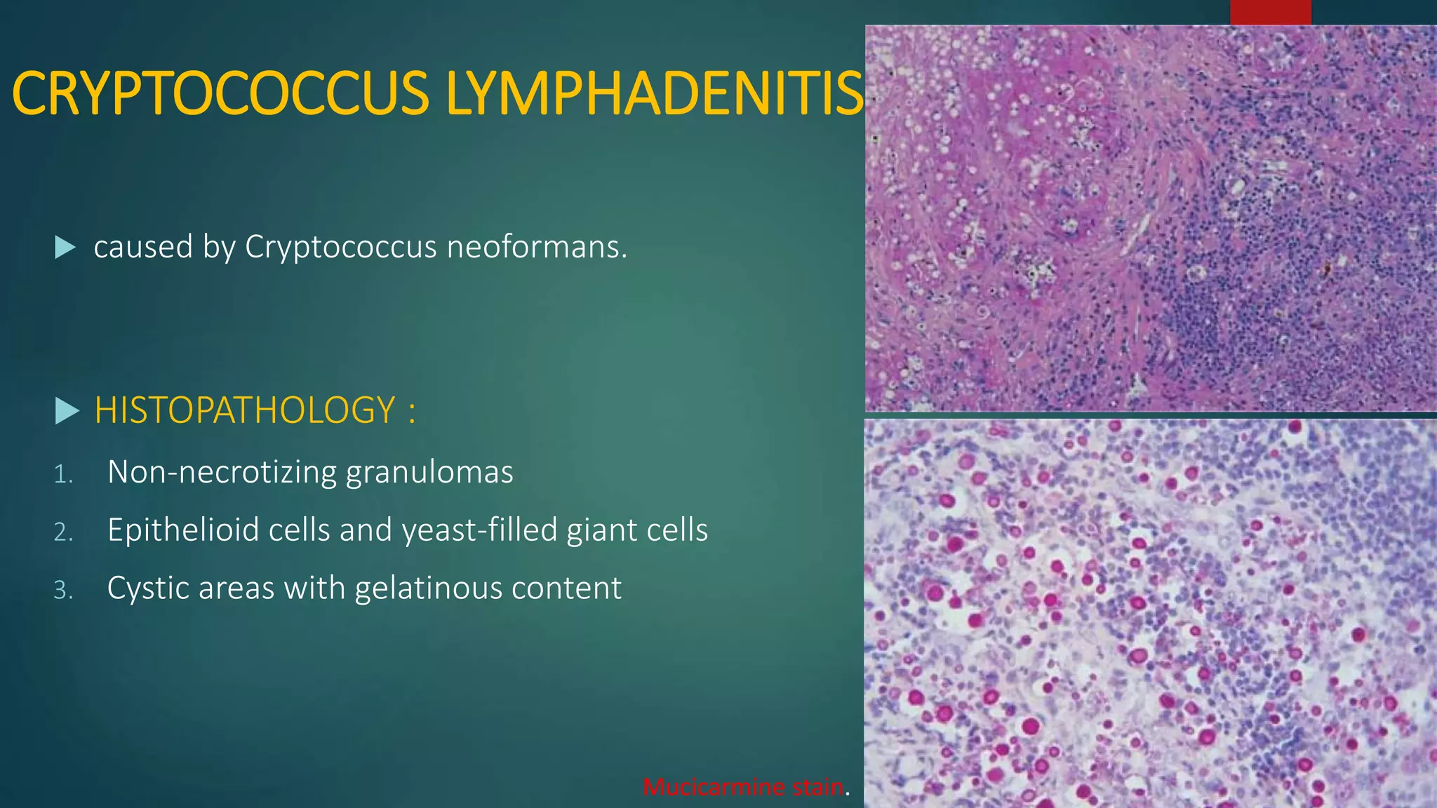 Non neoplastic lymphadenopathy | PPTX
