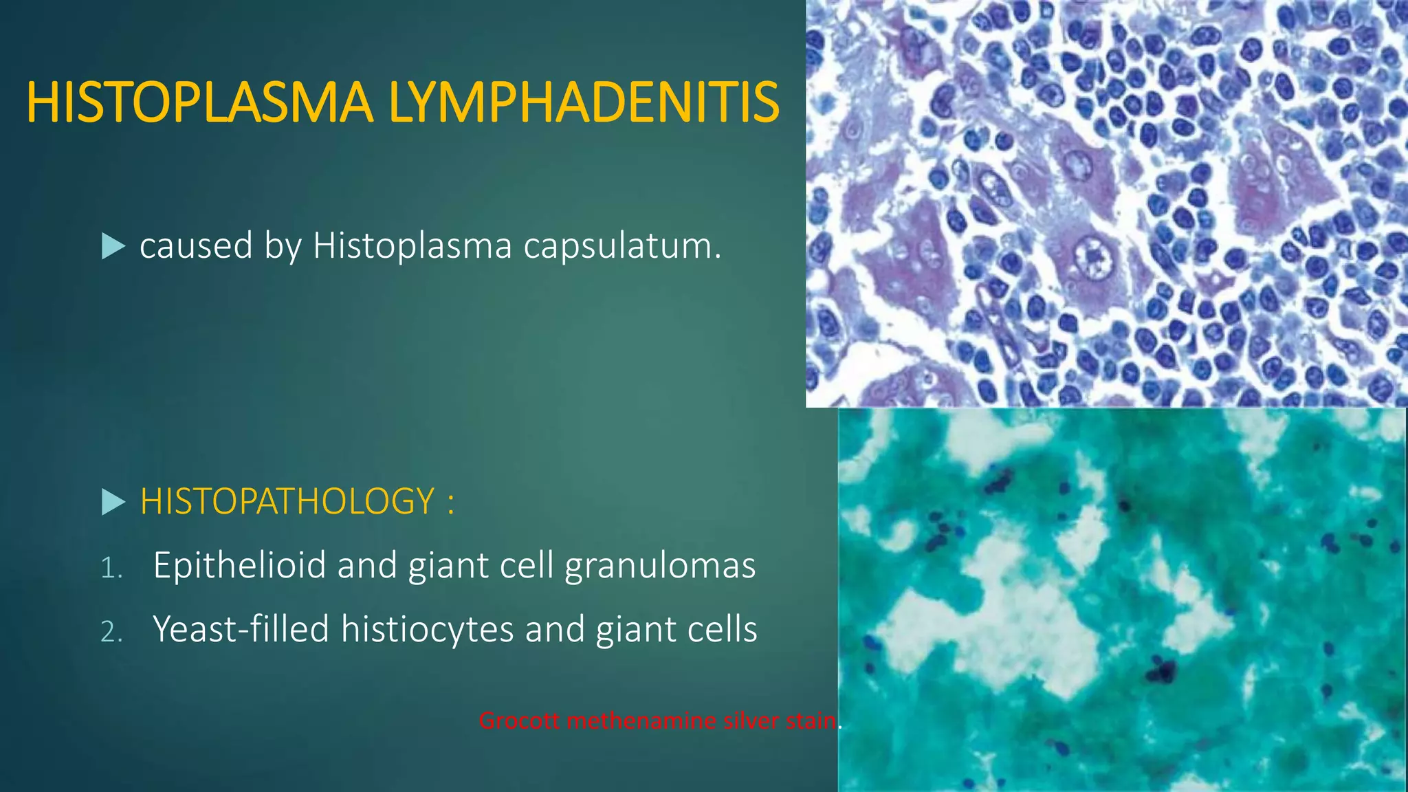 Non neoplastic lymphadenopathy | PPTX