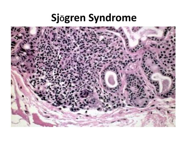 non neoplastic salivary gland diseases.ppt