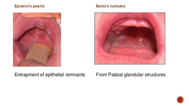 Non odontogenic cyst