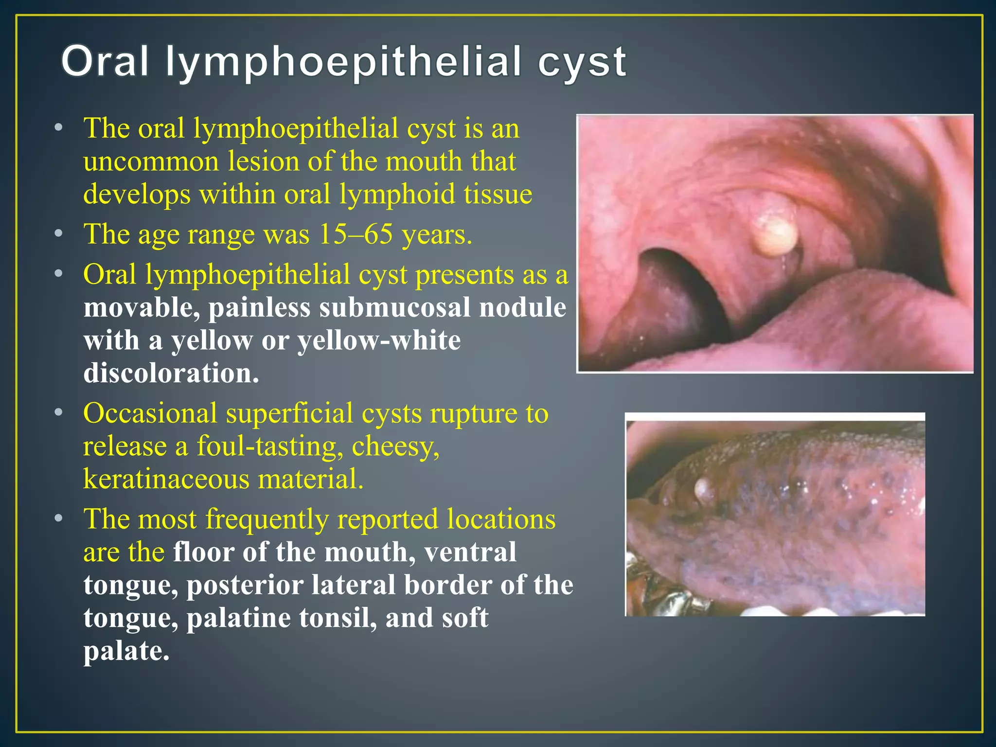 Non odontogenic cyst and pseudo cyst of the jaw- seminar 2- ORIGINAL.pptx | Ear, Nose and Throat ...