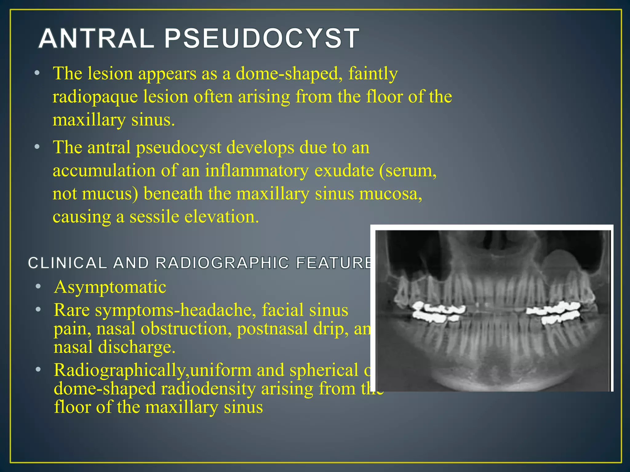 Non odontogenic cyst and pseudo cyst of the jaw- seminar 2- ORIGINAL.pptx