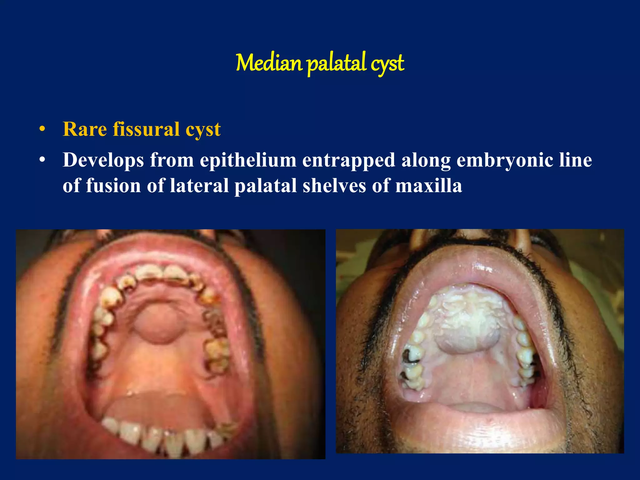 Non odontogenic cysts or fissural cysts | PPTX