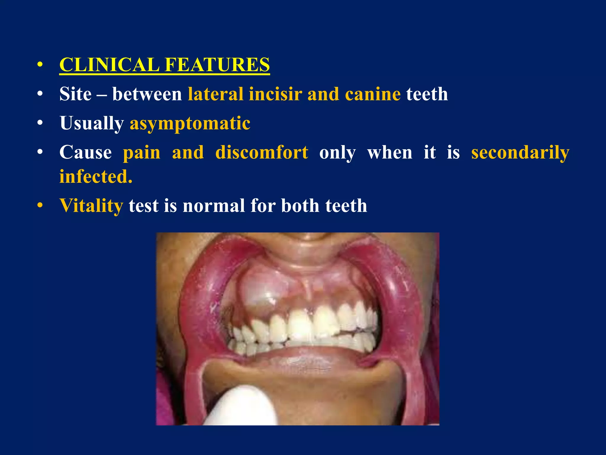 Non odontogenic cysts or fissural cysts | PPTX
