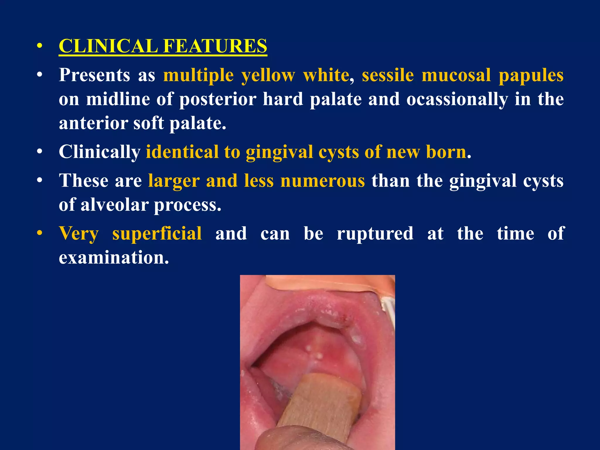 Non odontogenic cysts or fissural cysts | PPTX