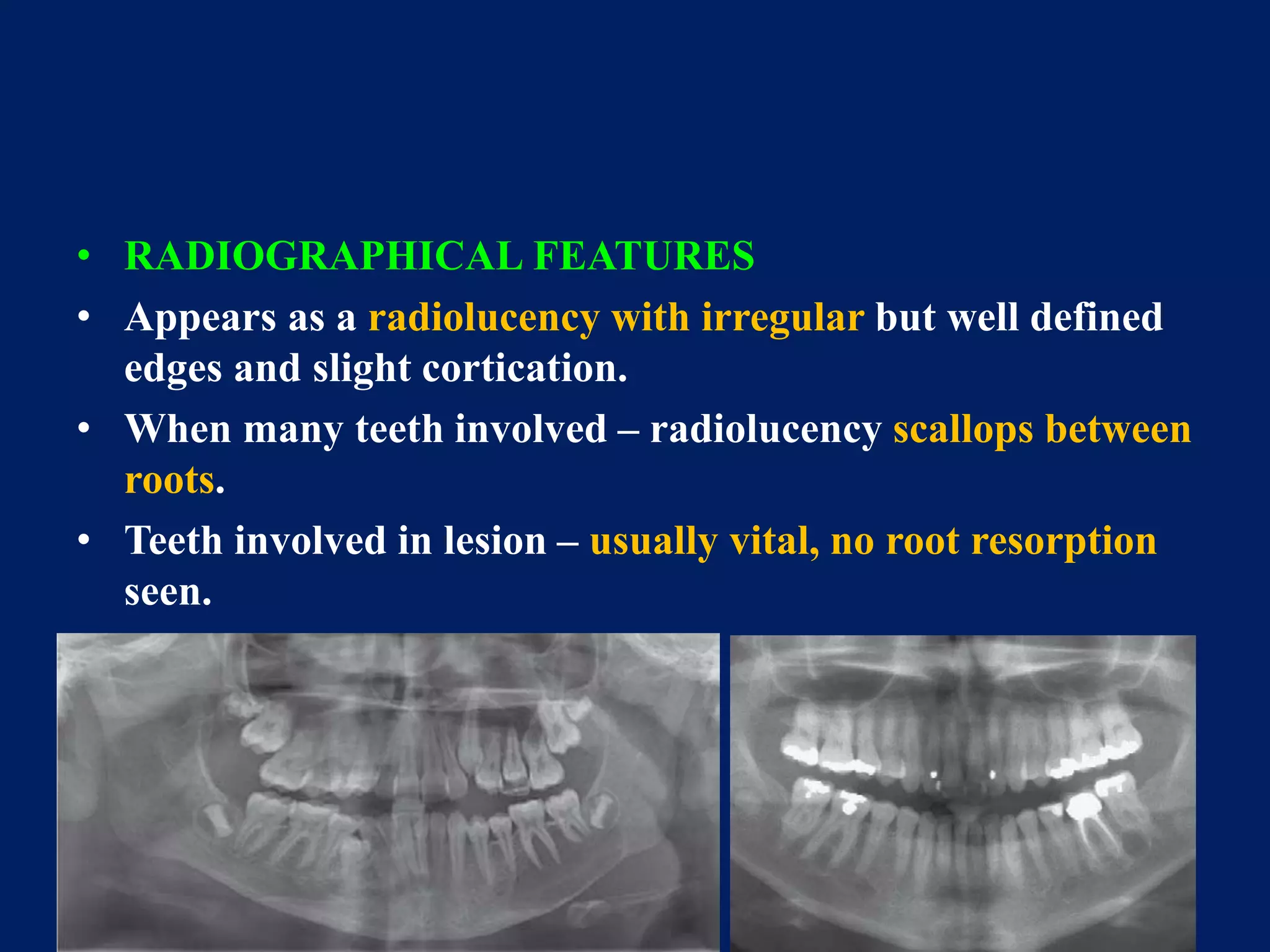 Non odontogenic cysts or fissural cysts | PPTX