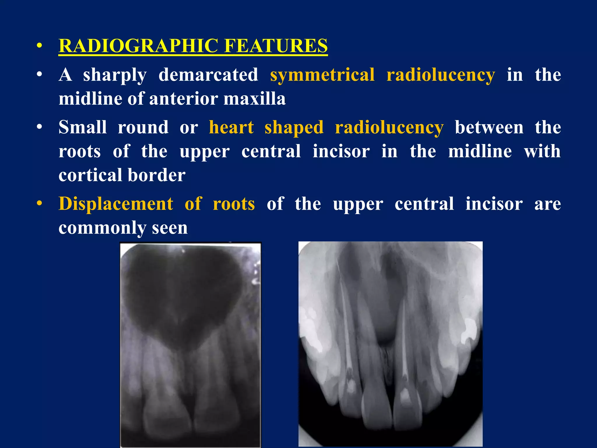 Non odontogenic cysts or fissural cysts | PPTX