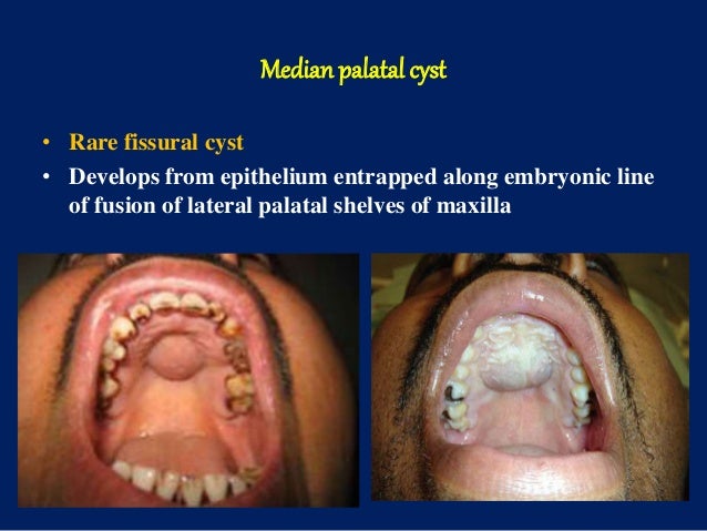 Non odontogenic cysts or fissural cysts