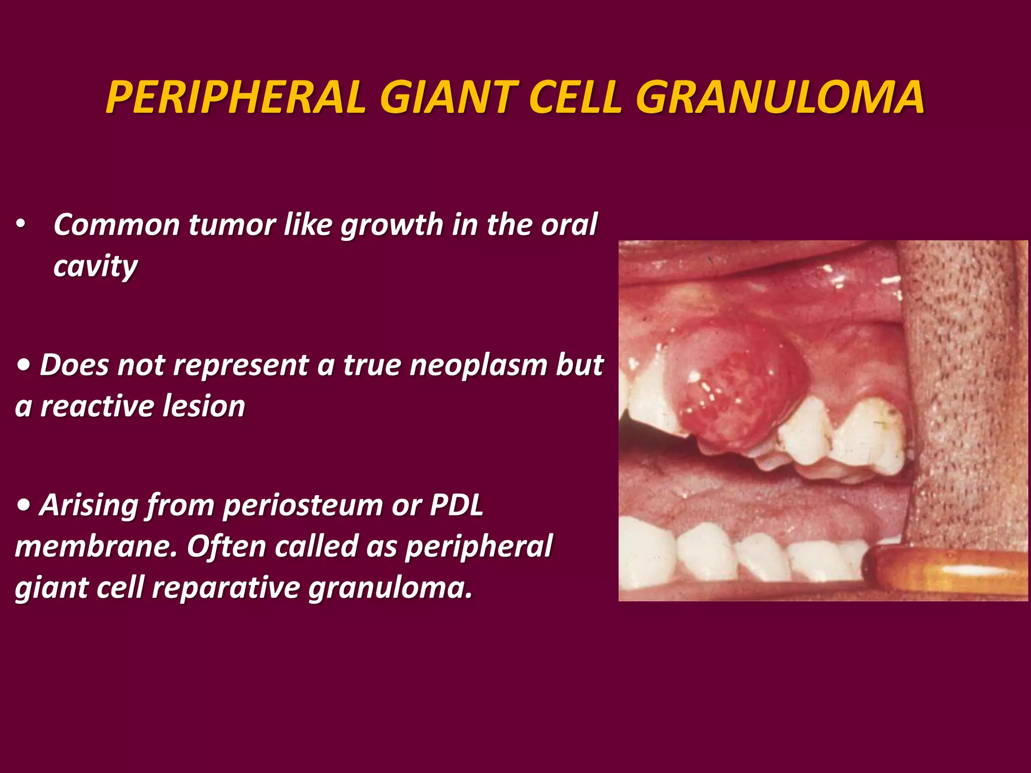Non odontogenic tumors | PPTX
