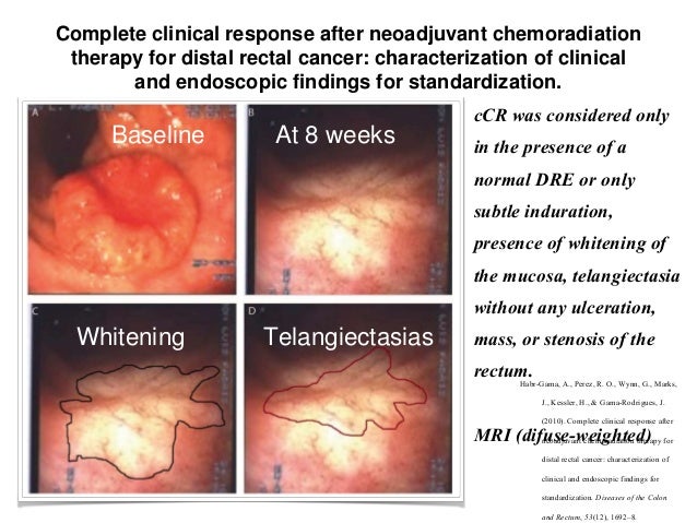Watch And Wait In Rectal Cancer