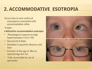 NON PARALYTIC SQUINT NEW dr maria nazish.pptx