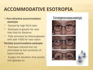 NON PARALYTIC SQUINT NEW dr maria nazish.pptx