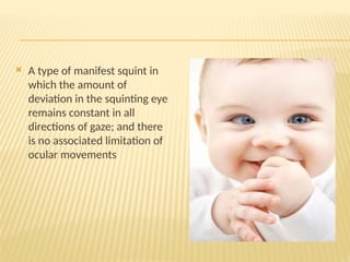 NON PARALYTIC SQUINT NEW dr maria nazish.pptx