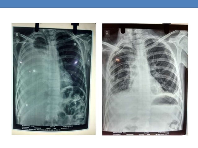 Non resolving pneumonia | PPTX | Lung and Respiratory Health | Diseases ...
