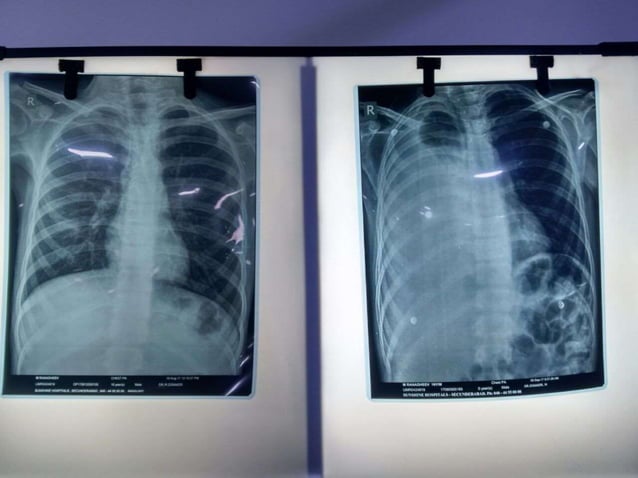 Non resolving pneumonia | PPTX | Lung and Respiratory Health | Diseases ...