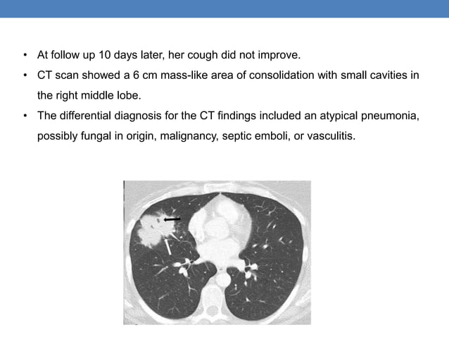 Non resolving pneumonia | PPTX | Lung and Respiratory Health | Diseases ...