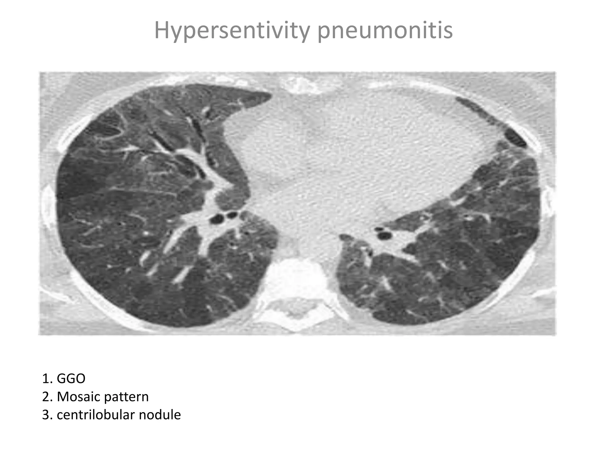 Non resolving pneumonia | PPTX