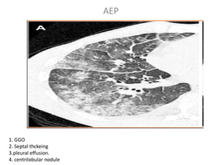 Non resolving pneumonia | PPTX
