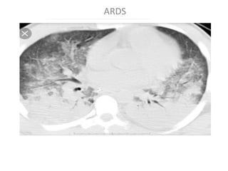 Non resolving pneumonia | PPTX